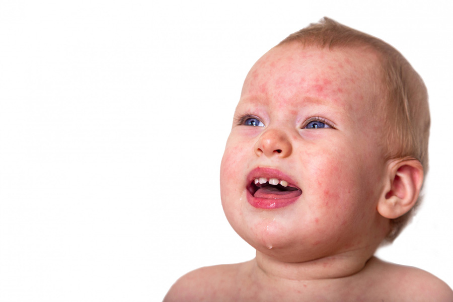 احمرار الخدود: تعرف على متلازمة الخد المصفوع أو المرض الخامس - منصة شفاء