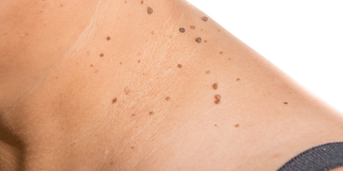 متى يجب القلق من وجود ثآليل على البشرة؟ - منصة شفاء